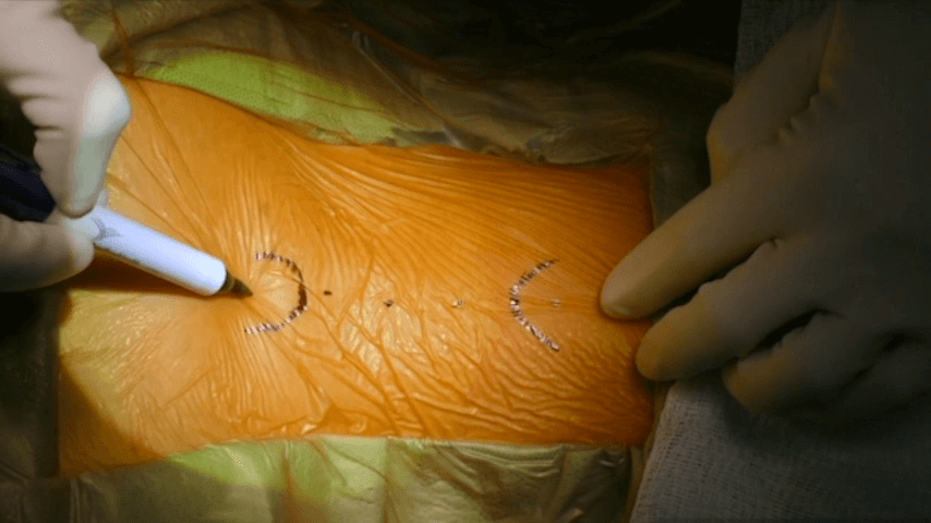 Posterior Cervical Laminectomy & Fusion: Marking and Making the ...