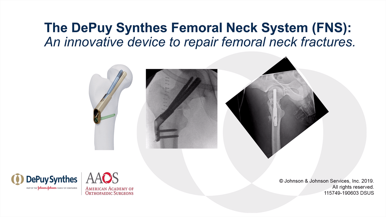 Femoral Neck System (FNS) - An Innovative Device to Repair Femoral Neck ...