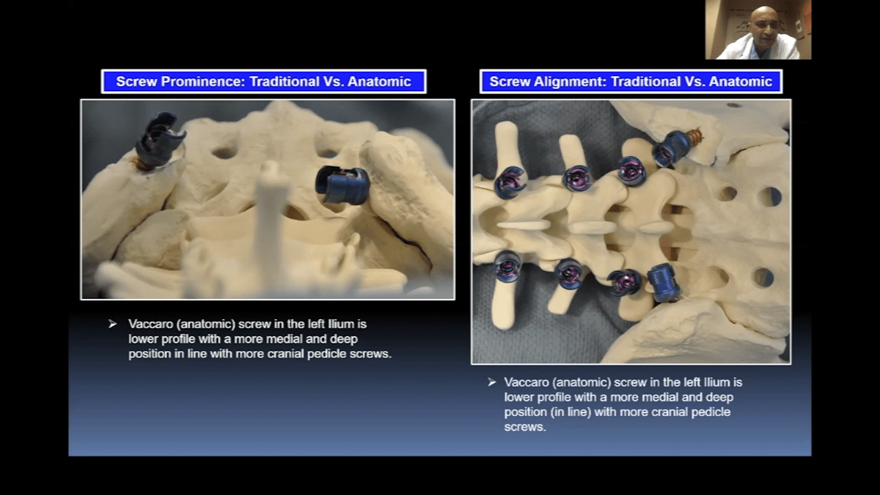 Sacropelvic Fixation & Iliac Crest Graft Surgical Demonstration: Screw ...