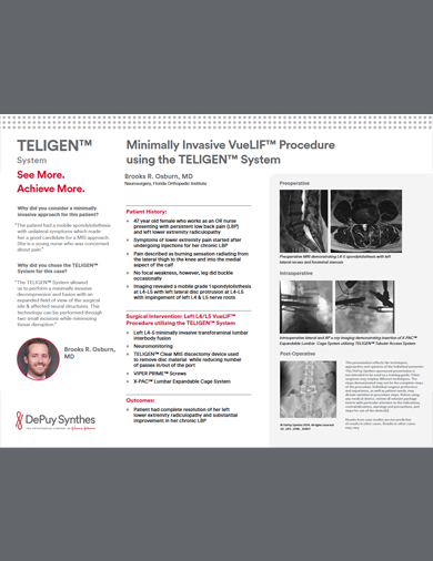 MIS TLIF Procedure using the TELIGEN™ System - Brooks Osburn, MD ...