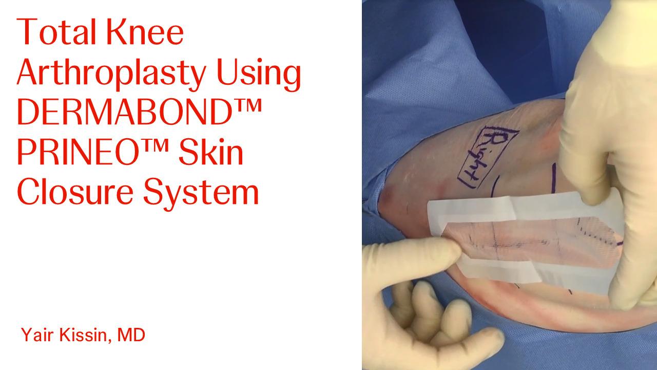 Using DERMABOND® PRINEO® Skin Closure System in TKA with Yair Kissin ...