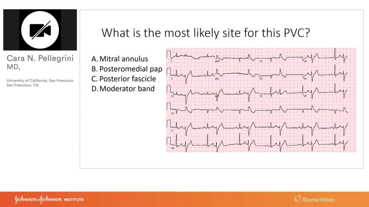 Clinical and ECG Recognition of the Malignant Mitral Valve Prolapse ...